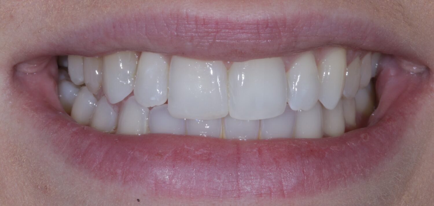 What The Dentist Wants You to Know About Veneers | Mint Dental