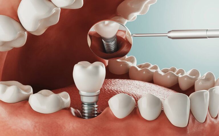 Palateless Dentures | Dentures That You Can Wear All the Time