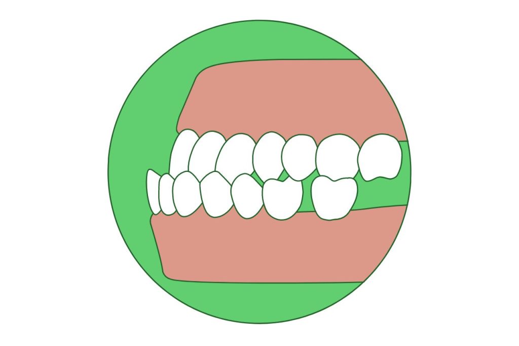 How to Fix an Underbite - The Easy Way | Mint Dental SE1