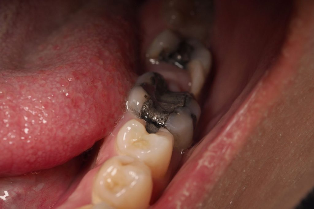 What You Need to Know About The Dental Amalgam Ban | Mint Dental SE1