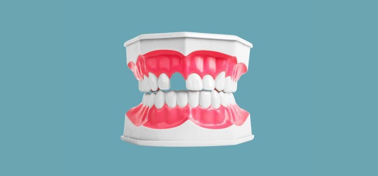 How Long Does a Loose Tooth Take to Fall Out in Adults? | Mint Dental SE1
